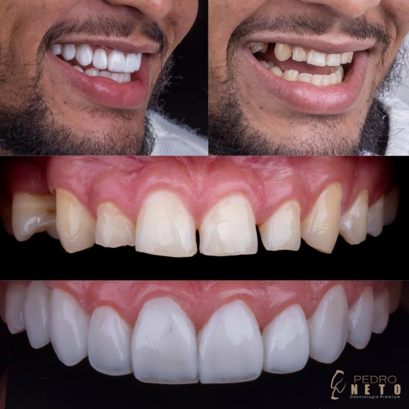 RESINAS COMPOSTAS - Clínica Odontoellos